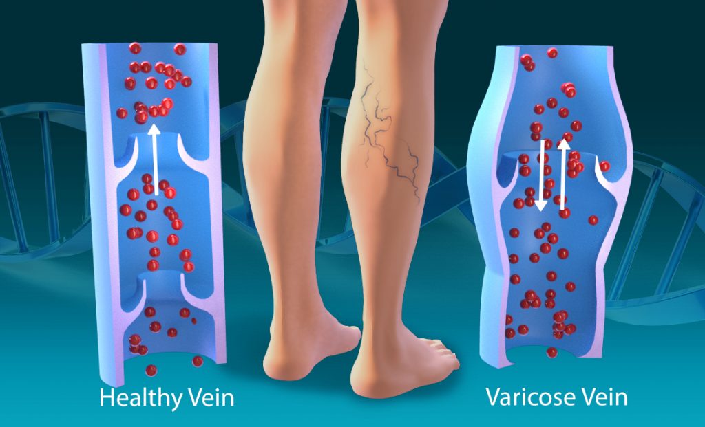 Computational Study Finds Genetic Links, Therapy Targets for Varicose ...